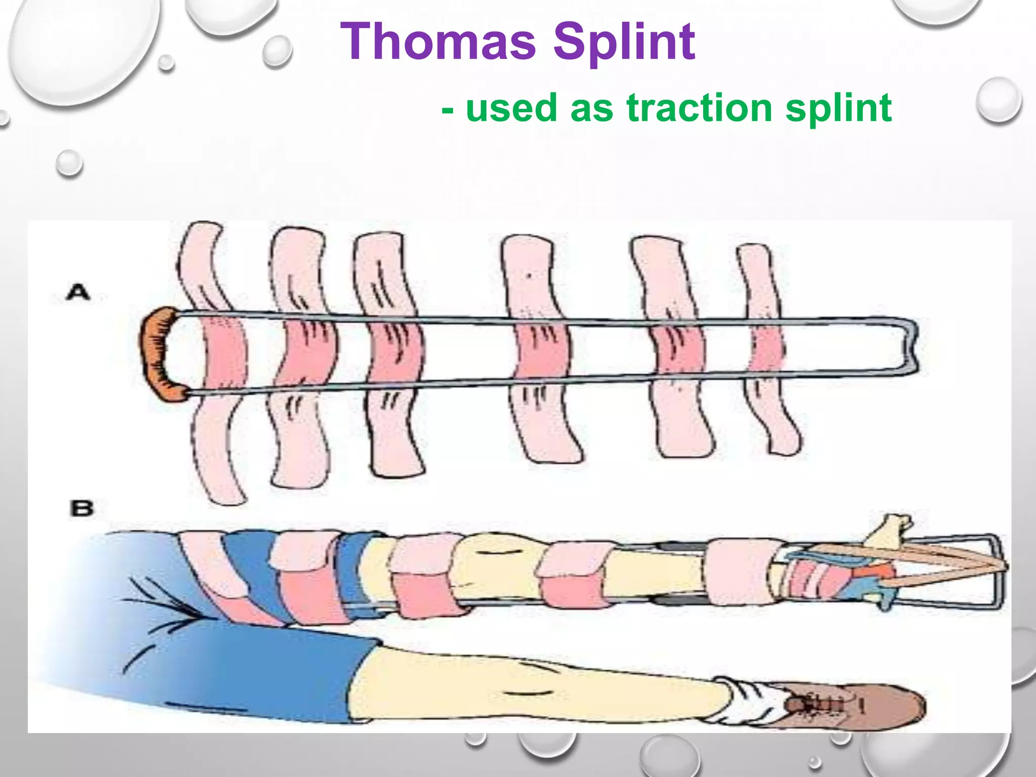 Splint ppt by rupeshkumar | PPTX
