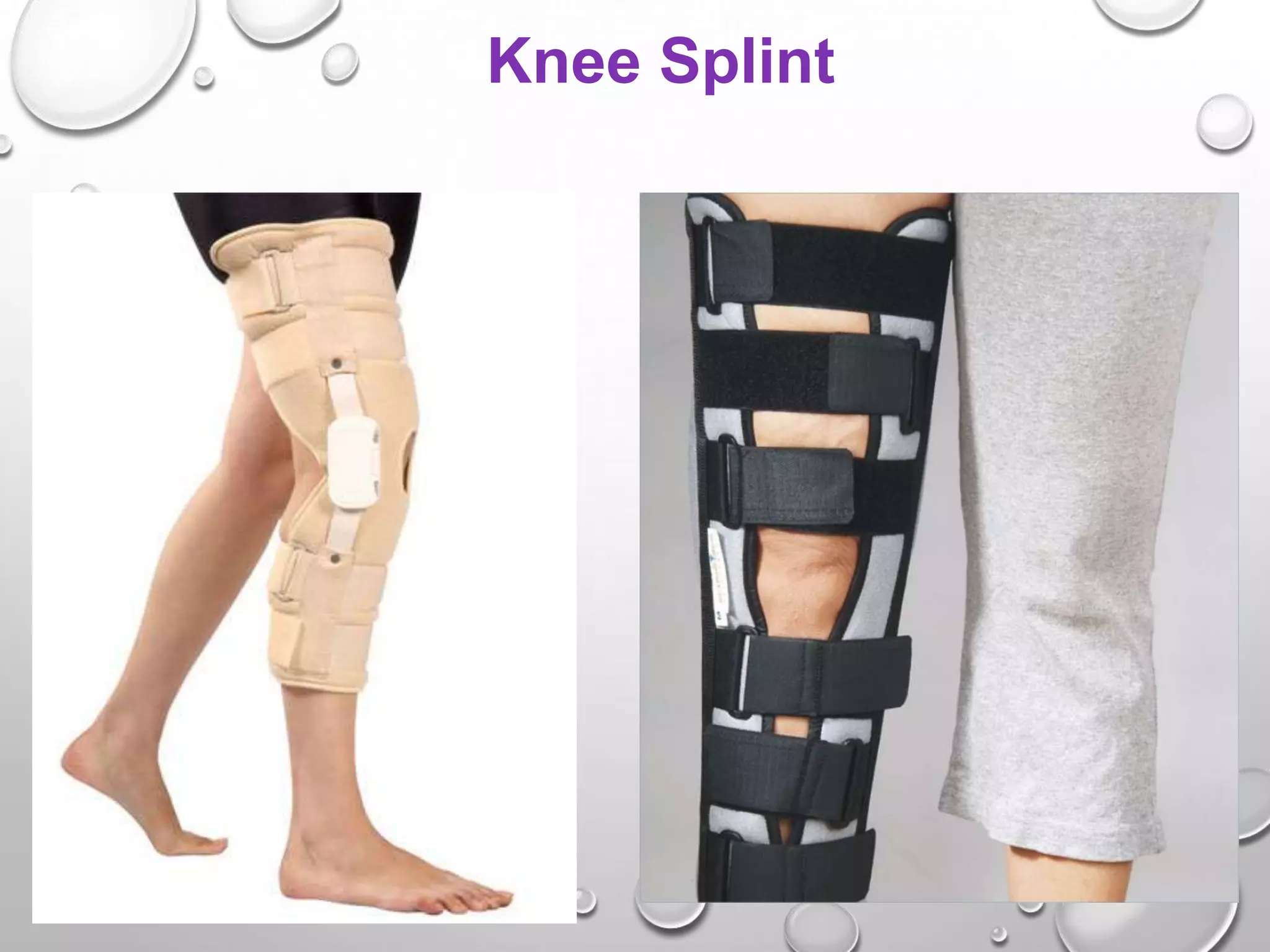 Splint ppt by rupeshkumar | PPTX