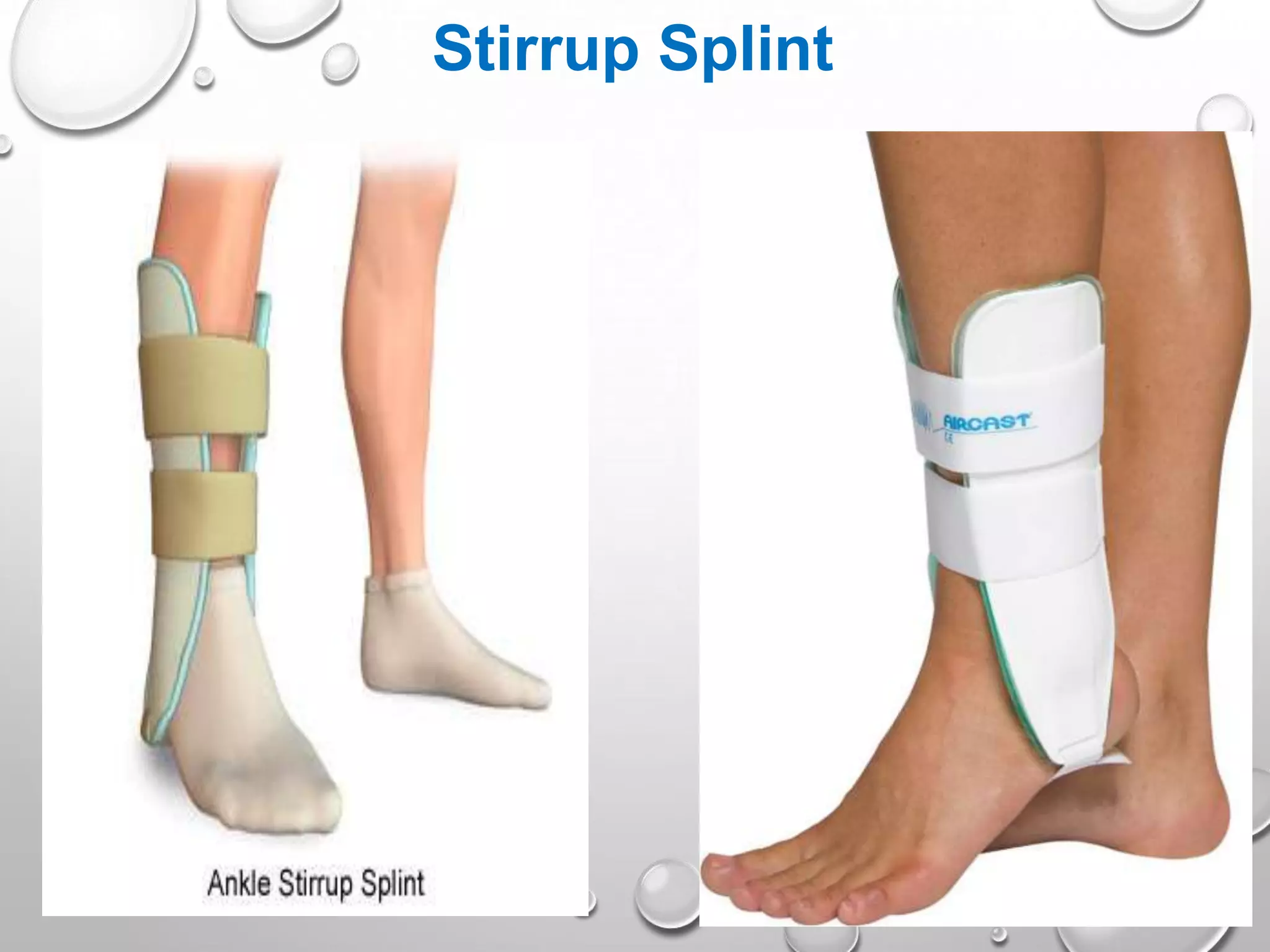 Splint ppt by rupeshkumar | PPTX
