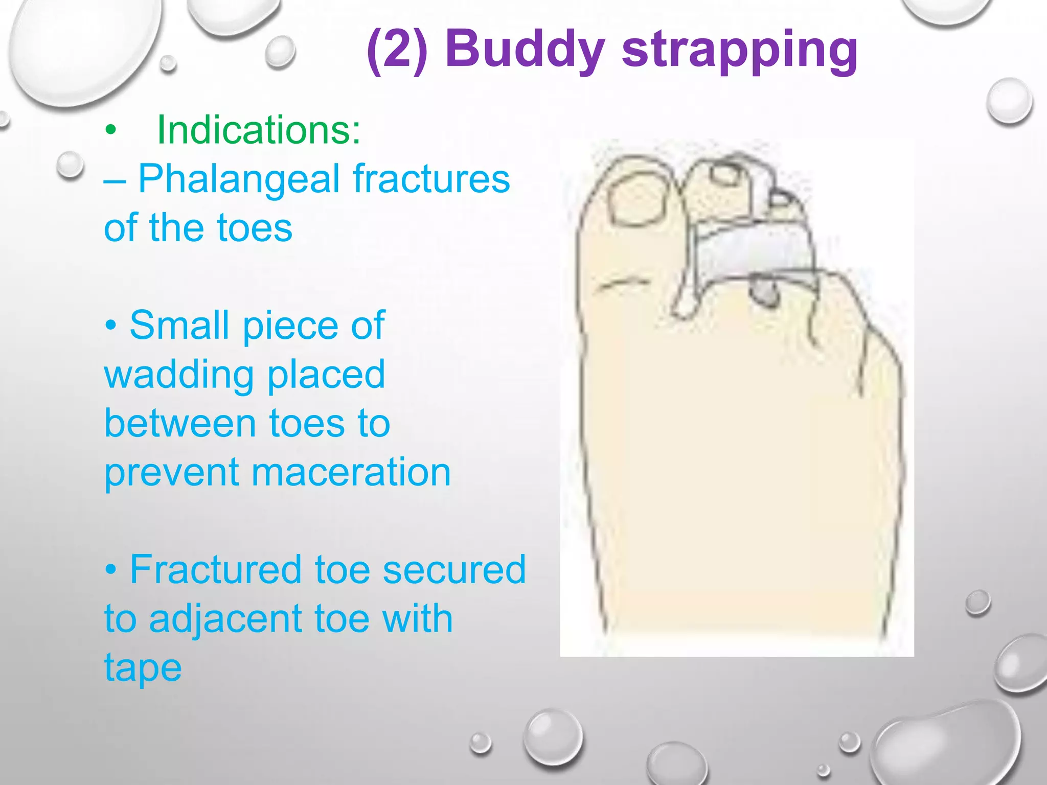 Splint ppt by rupeshkumar | PPTX