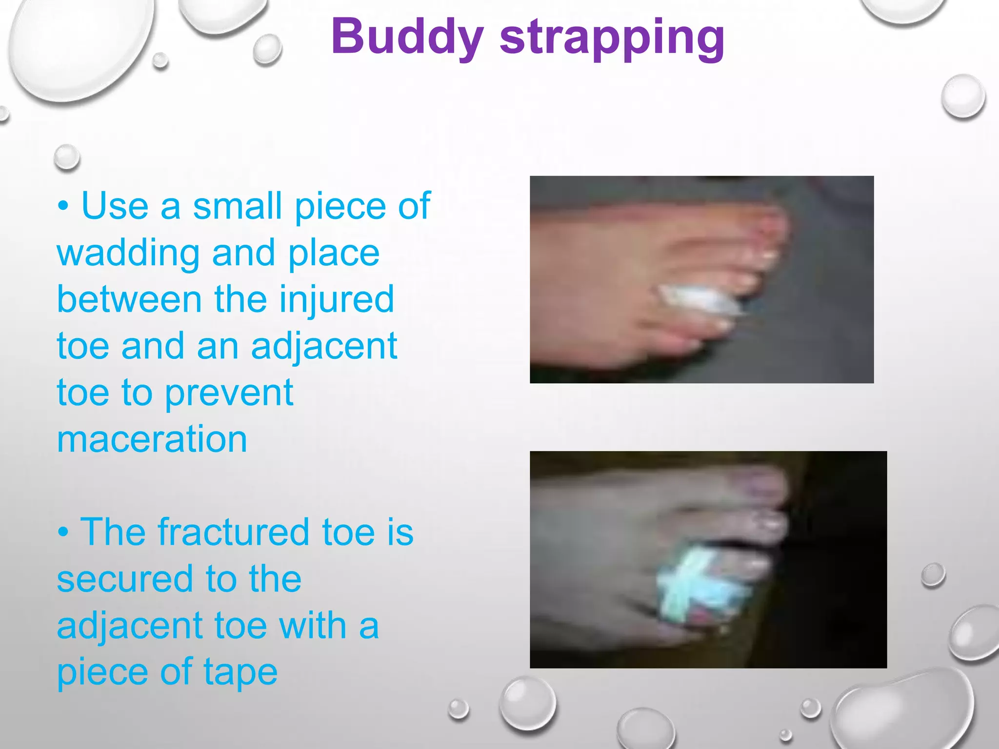 Splint ppt by rupeshkumar | PPTX