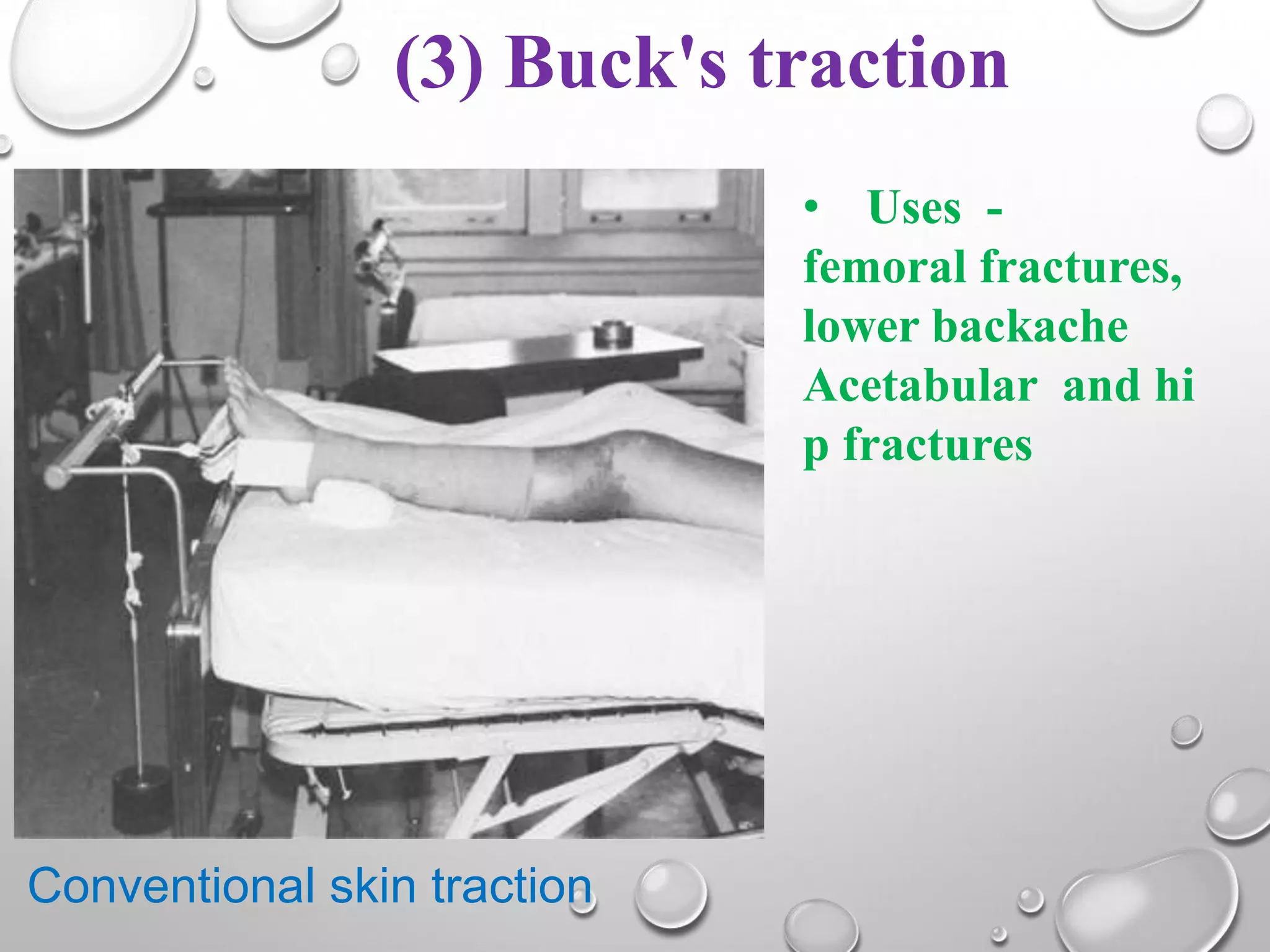 Splint ppt by rupeshkumar | PPTX