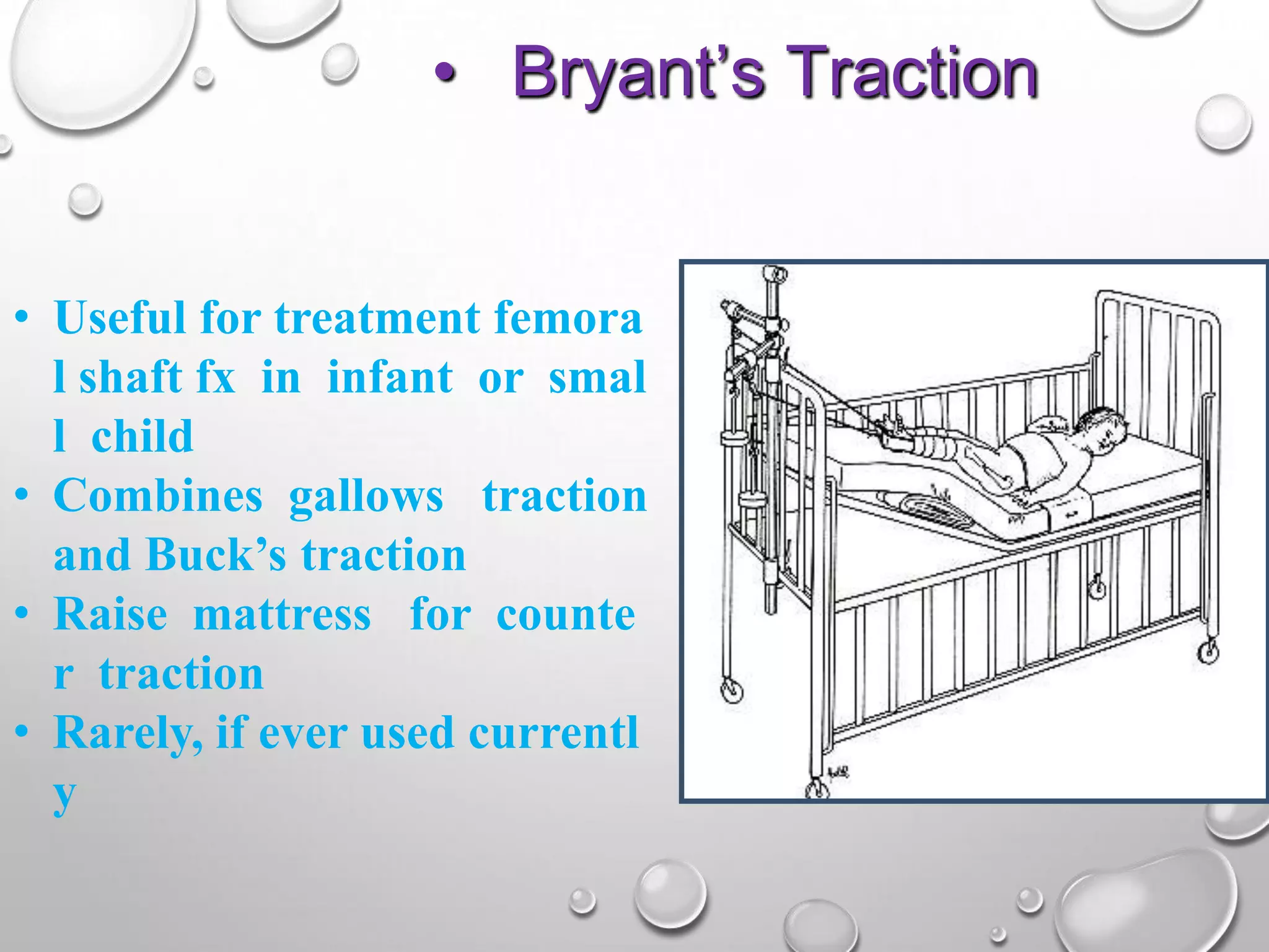 Splint ppt by rupeshkumar | PPTX