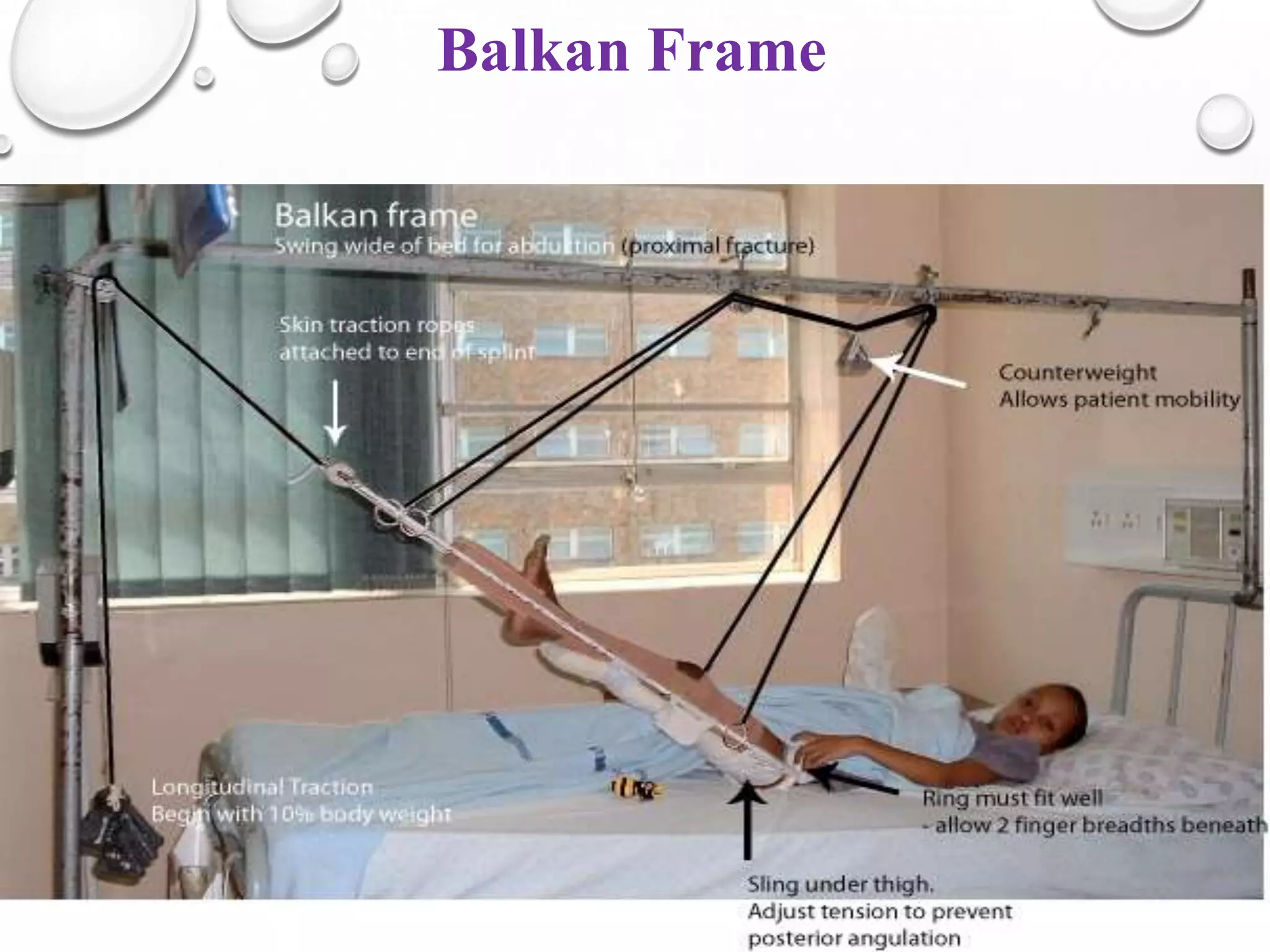 Splint ppt by rupeshkumar | PPTX