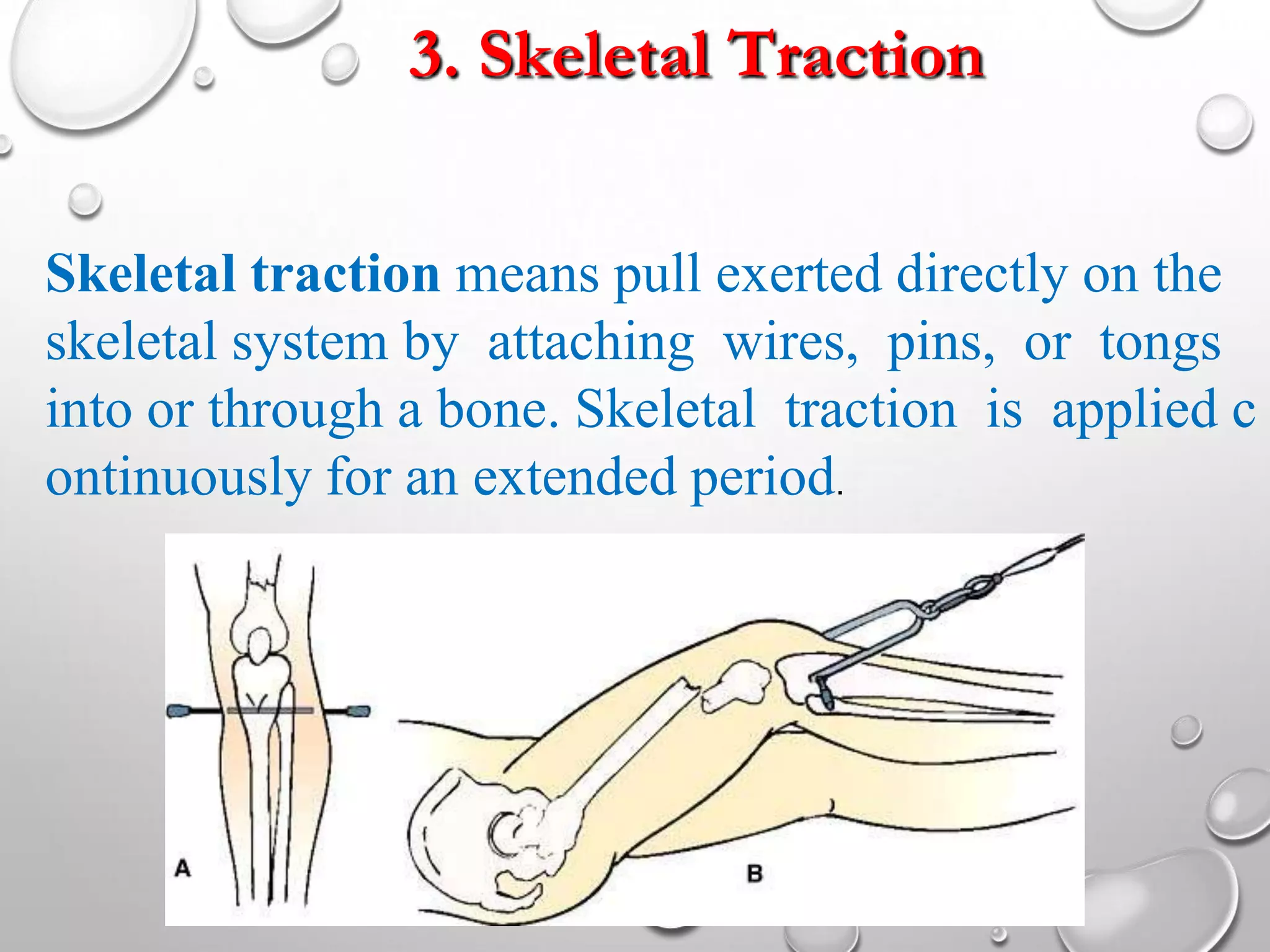 Splint ppt by rupeshkumar | PPTX