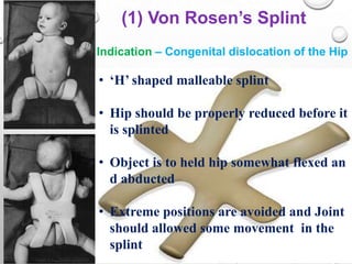 Splint ppt by rupeshkumar | PPTX
