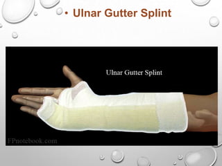 Ulnar Gutter Splint