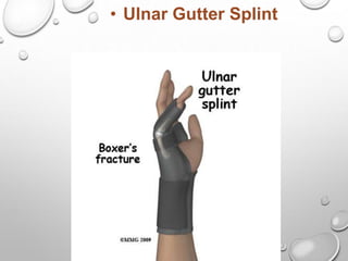 Ulnar Gutter Splint For 5th Metacarpal Fracture