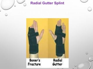 Radial Gutter Splint Pattern
