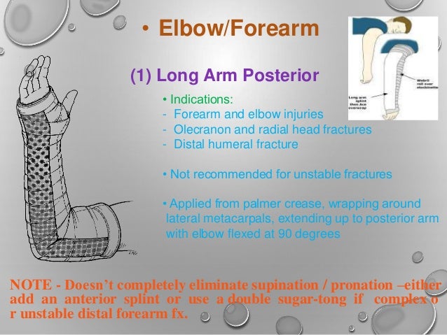 Splint ppt by rupeshkumar