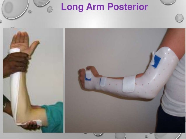 Splint ppt by rupeshkumar