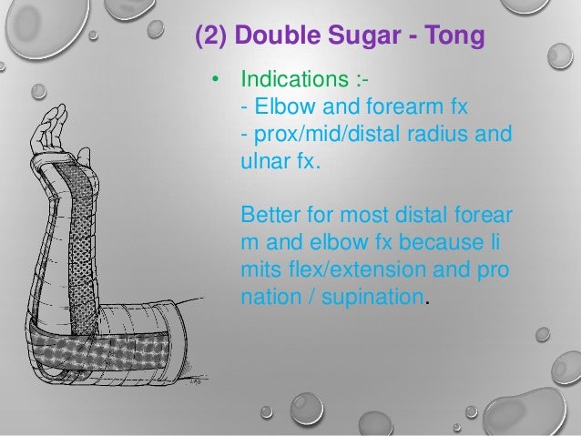 Splint ppt by rupeshkumar