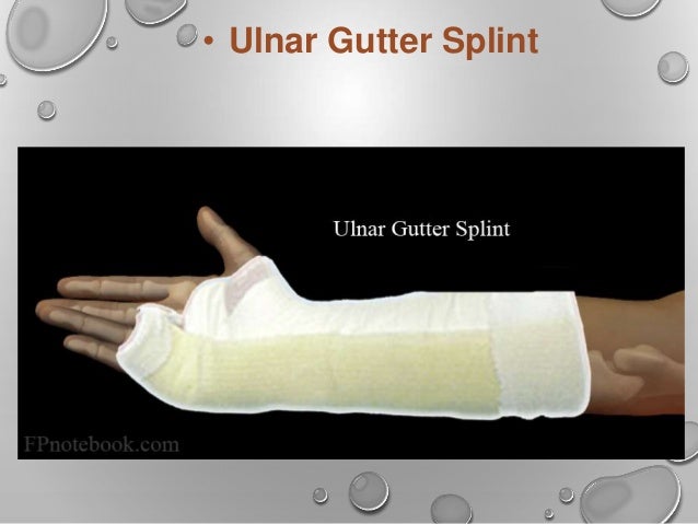 Ulnar Gutter Splint