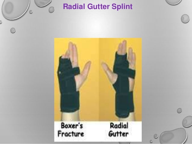 Splint ppt by rupeshkumar