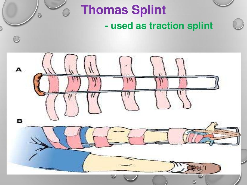 Splint ppt by rupeshkumar