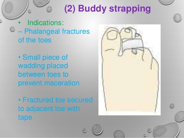 Splint ppt by rupeshkumar
