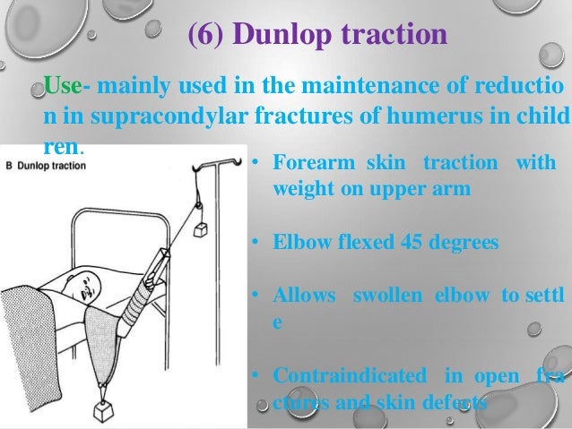 Splint ppt by rupeshkumar