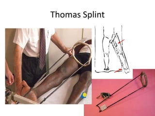 Splints | PPTX