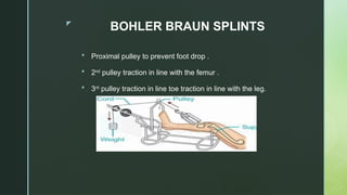 Various types of splints and basic PPT.. | PPT | Free Download