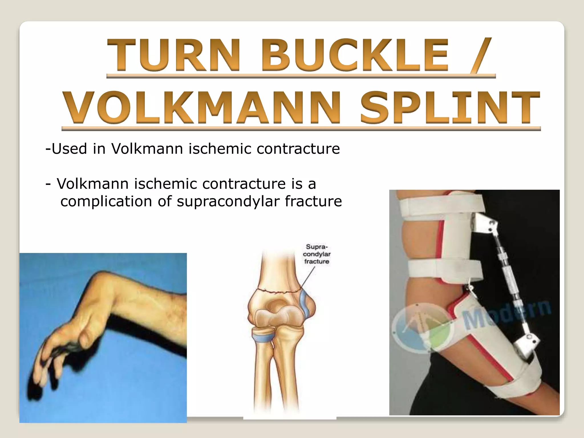 Splints and tractions | PPT