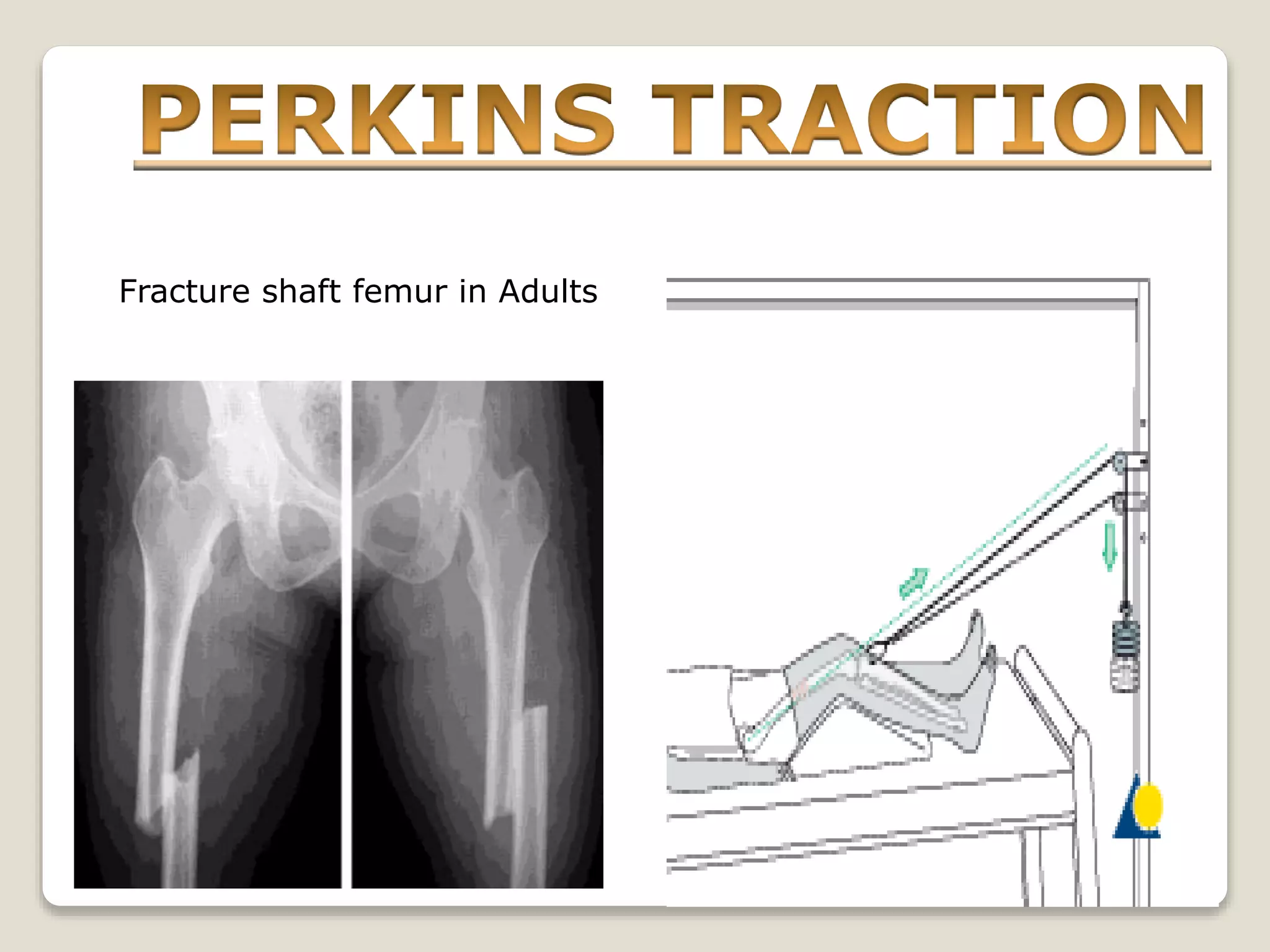 Splints and tractions | PPT