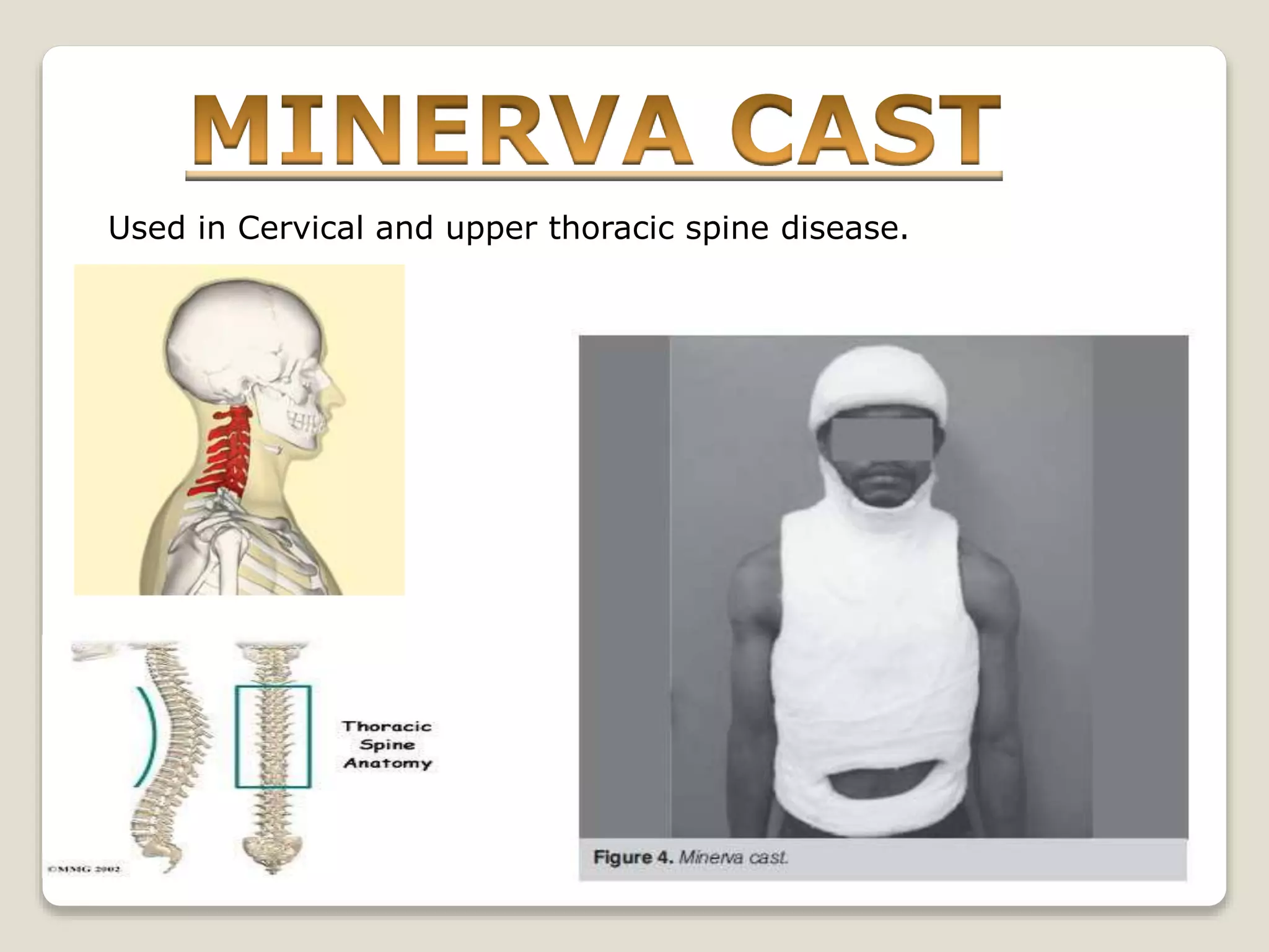 Splints and tractions | PPT