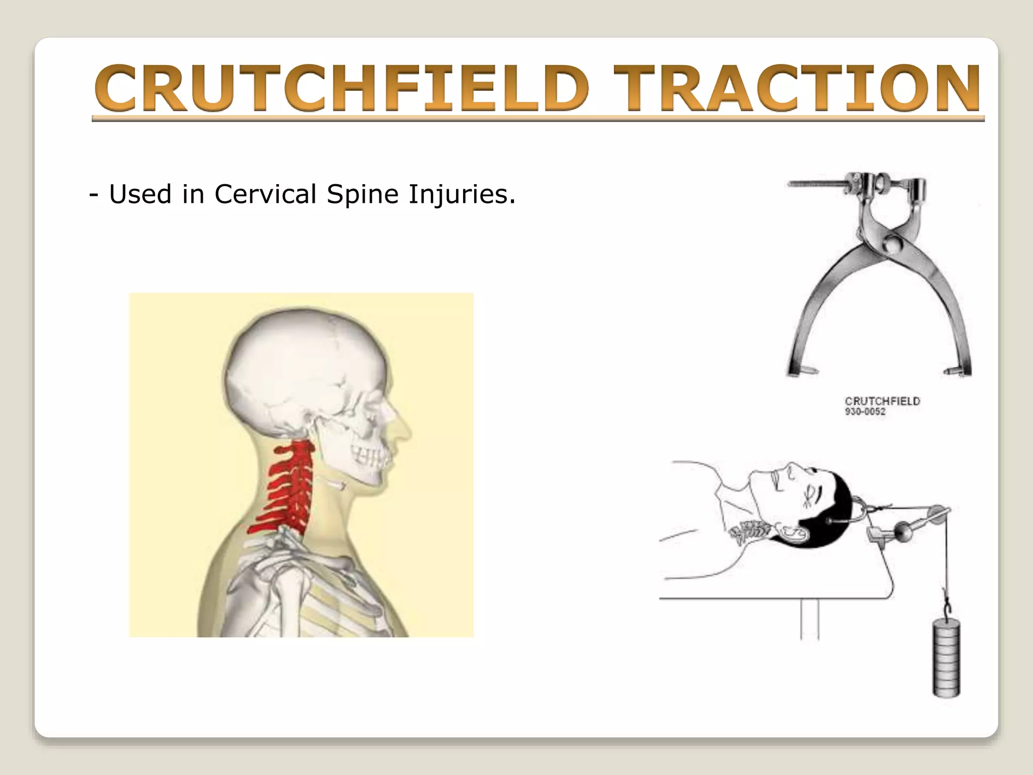 Splints and tractions | PPT