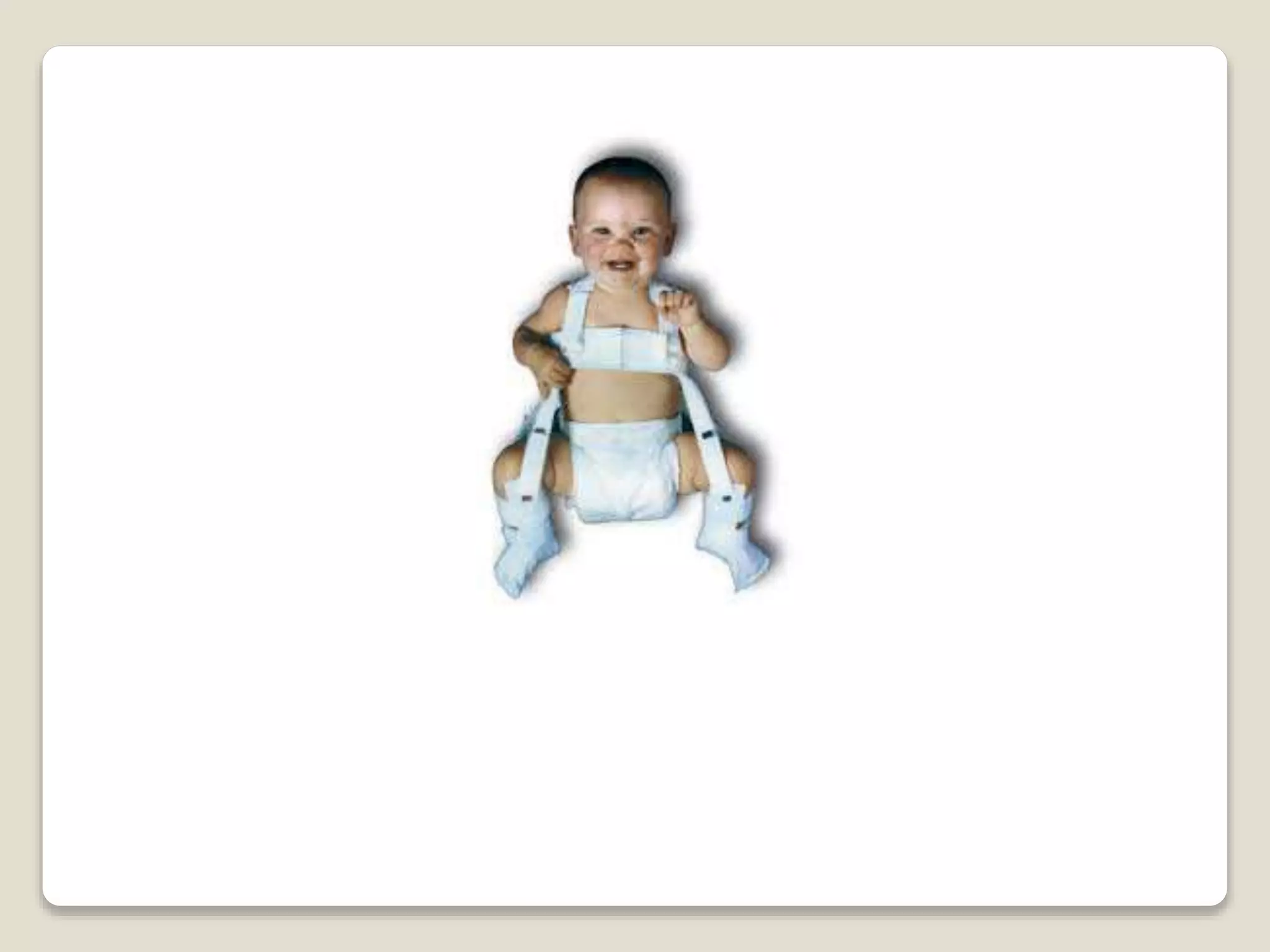 Splints and tractions | PPT