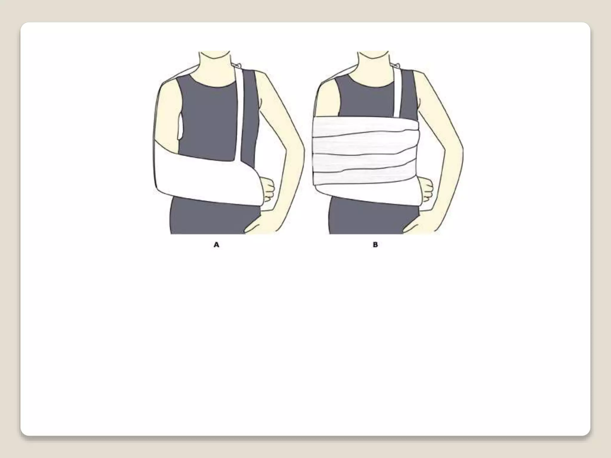 Splints and tractions | PPT