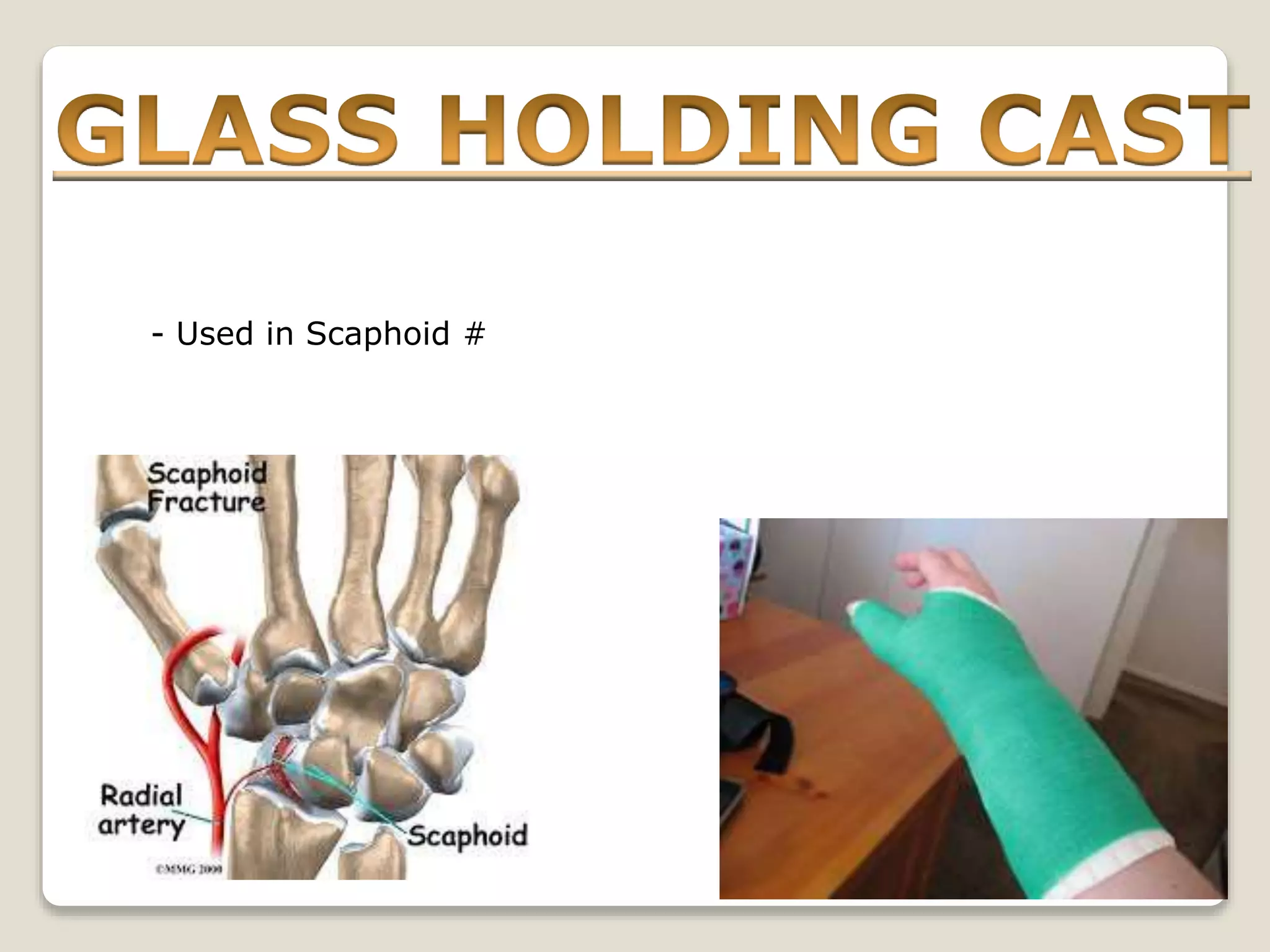 Splints and tractions | PPT