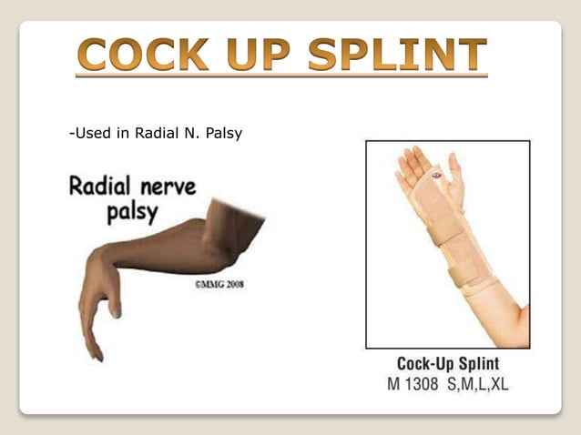 Splints and tractions | PPT