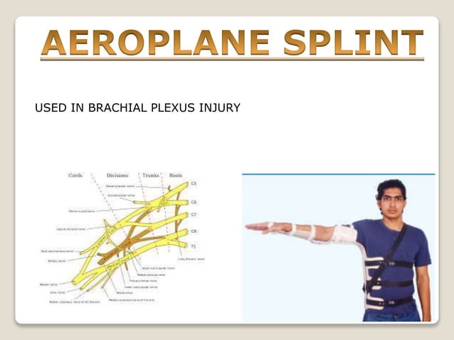 Splints and tractions | PPT