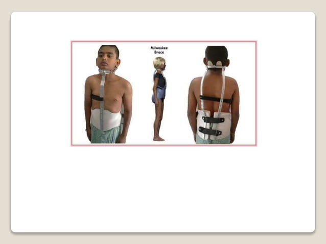 Splints and tractions | PPT