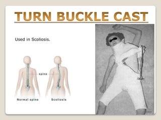 Risser Cast Scoliosis