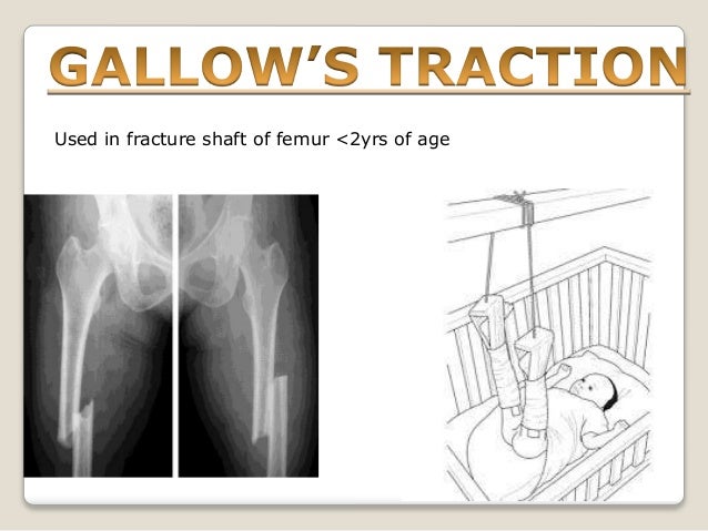 Splints and tractions