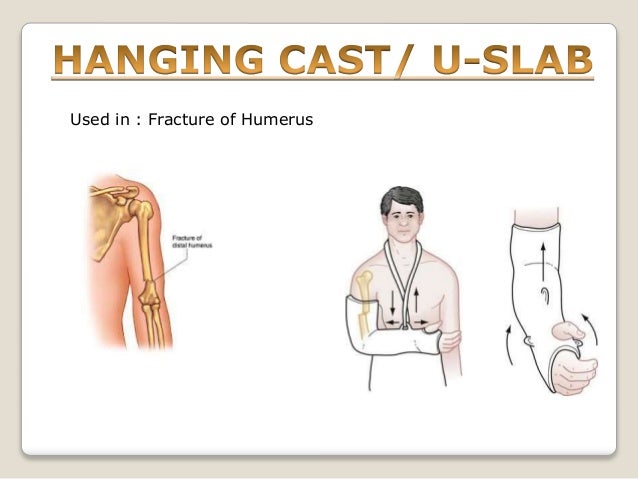 Proximal Humerus Fracture Cast