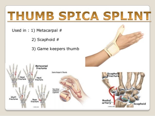 Splints and tractions