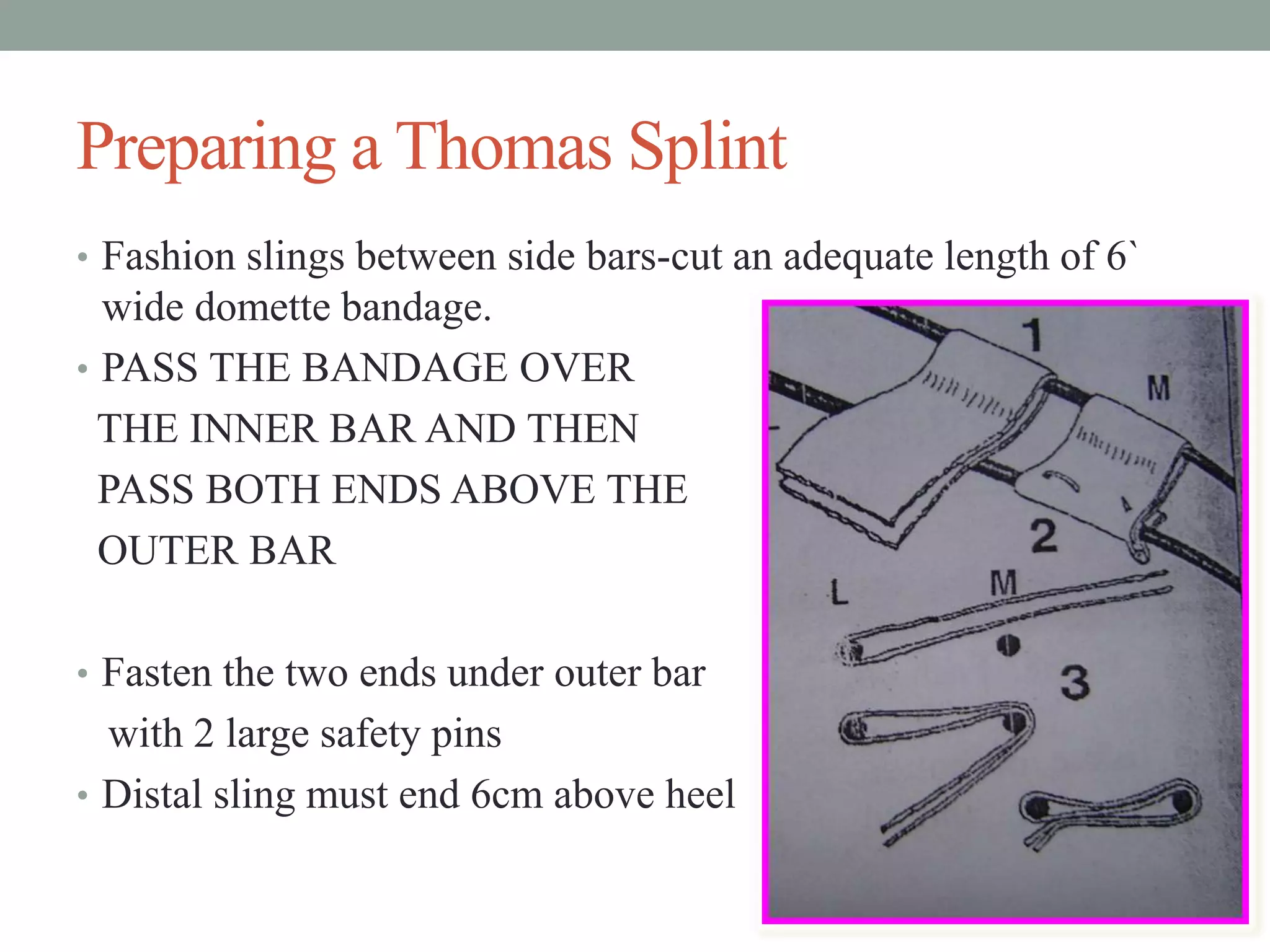 Splints and tractions | PPTX