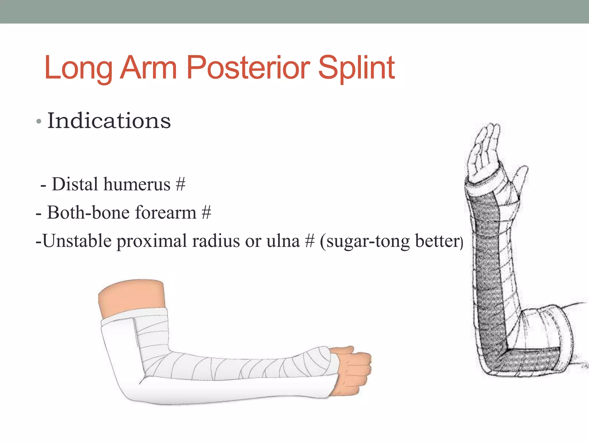 Splints and tractions | PPTX