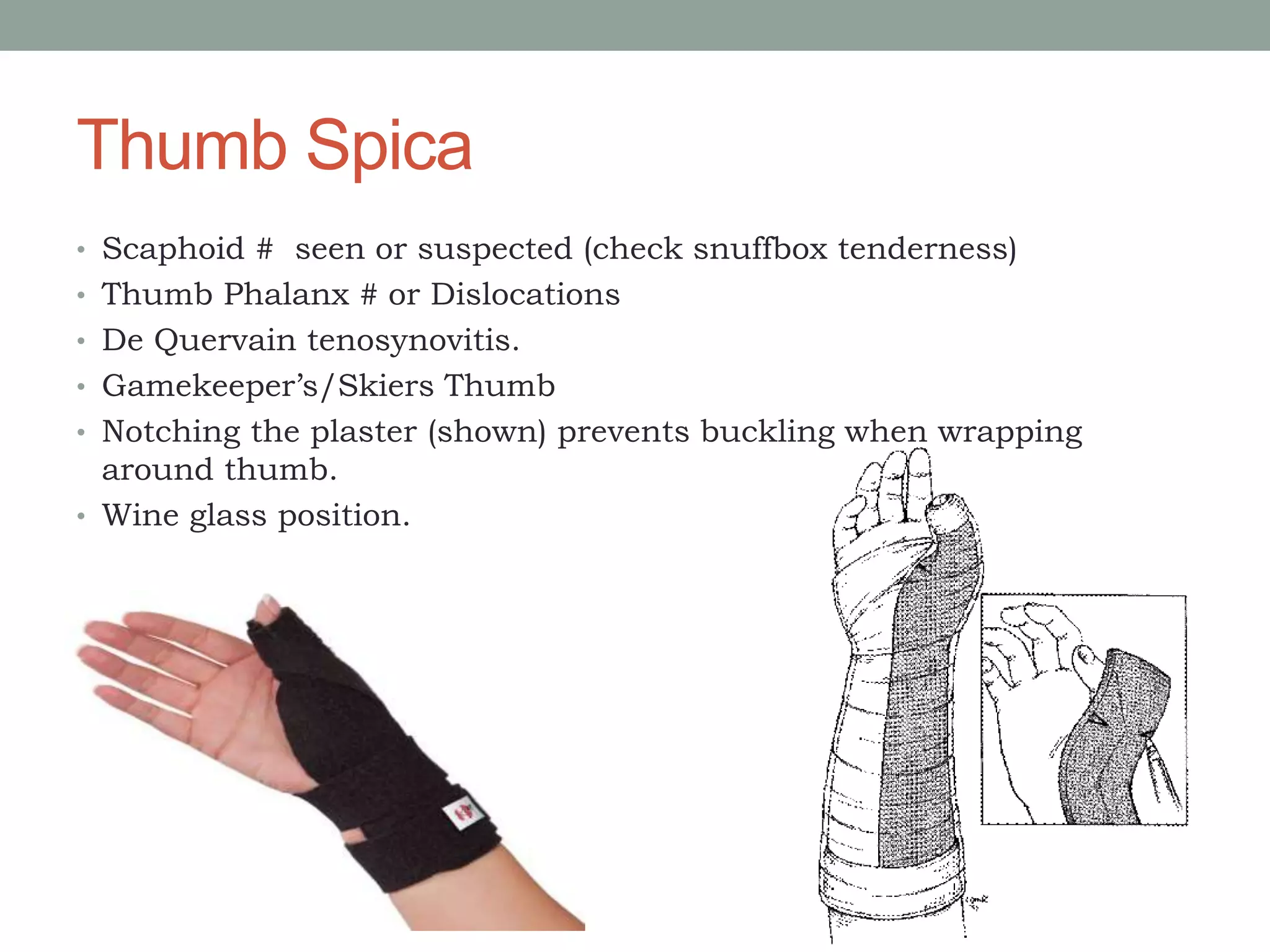 Splints and tractions | PPTX