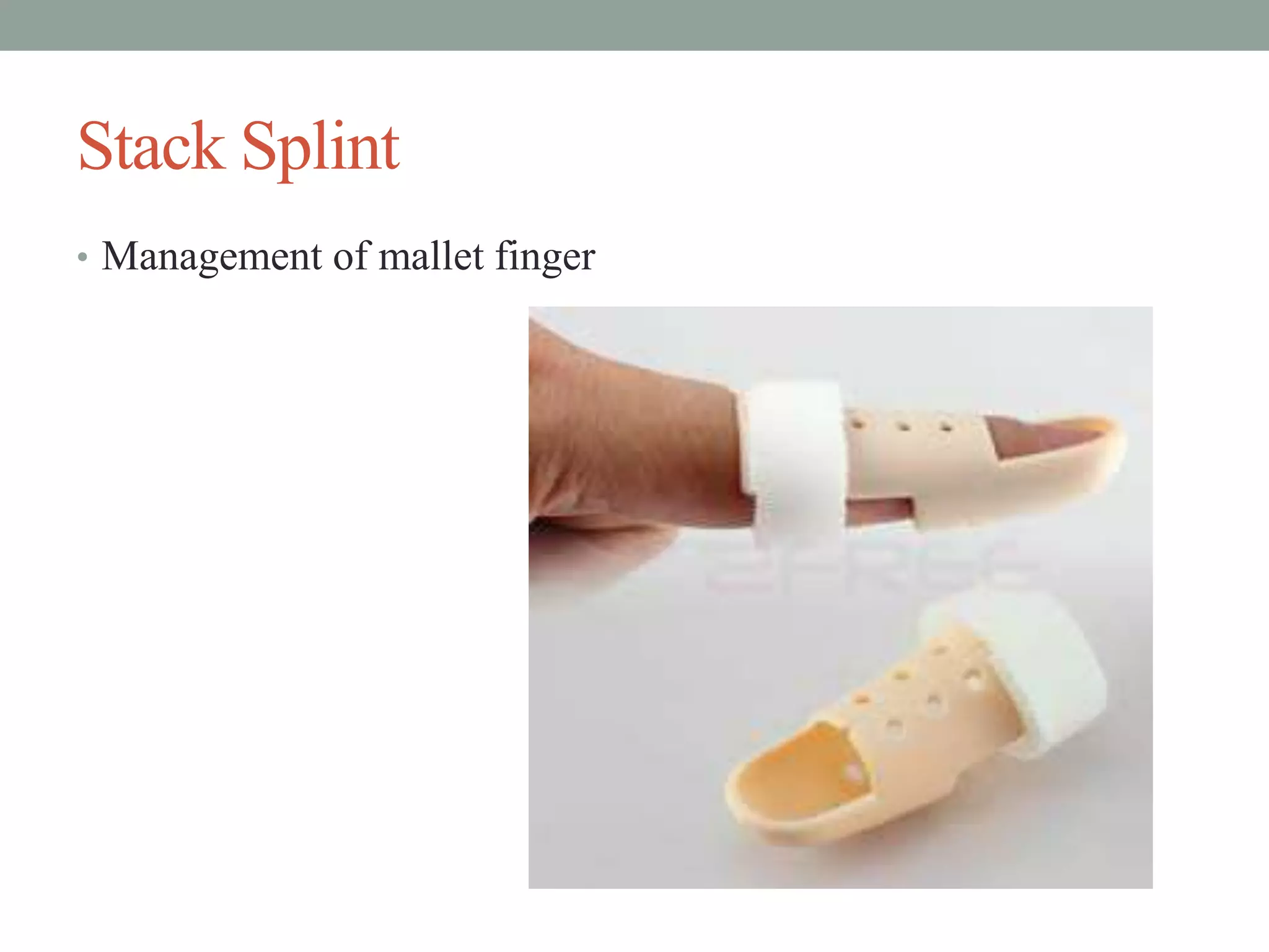 Splints and tractions | PPTX