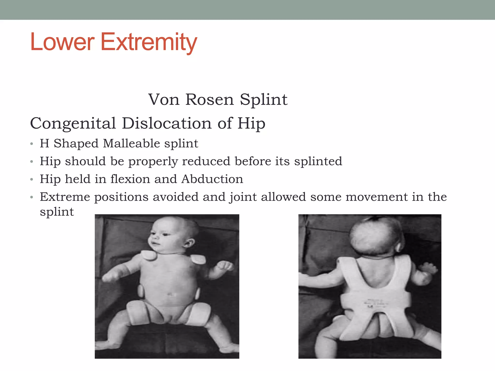 Splints and tractions | PPTX
