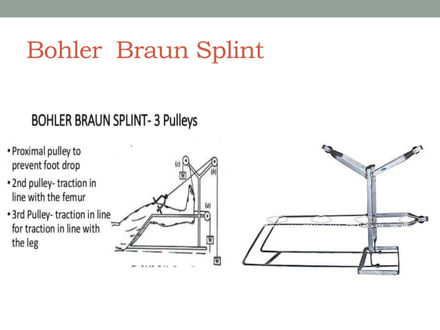 Splints and tractions | PPTX