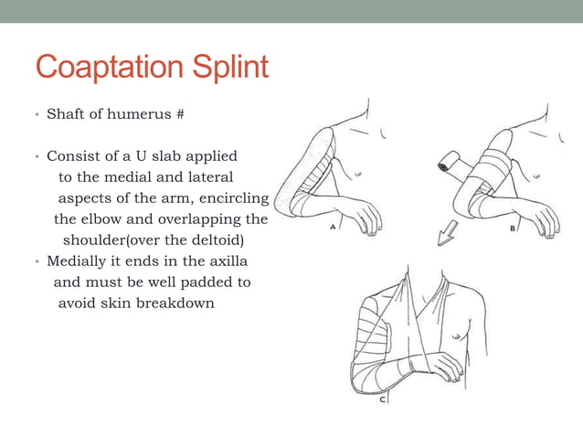 Splints and tractions | PPTX