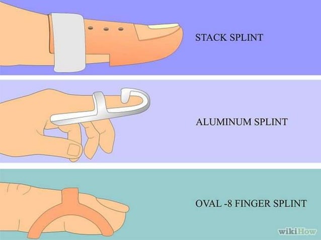 Splints and tractions | PPTX
