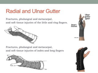 Ulnar Gutter Splint Ortho Glass