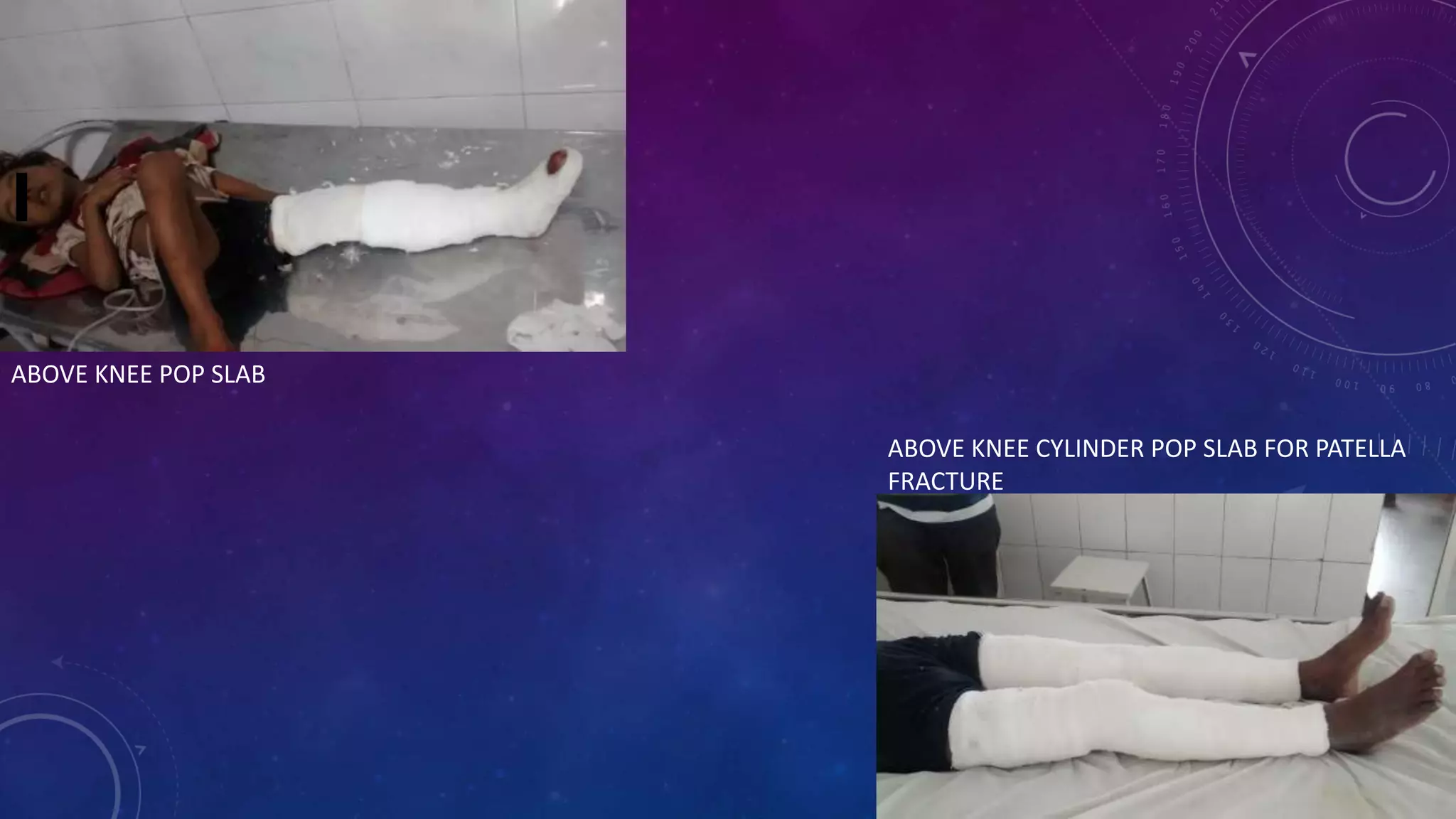 SPLINTS_AND_TRACTIONS_IN_ORTHOPAEDICS.pptx | Free download