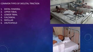 SPLINTS_AND_TRACTIONS_IN_ORTHOPAEDICS.pptx