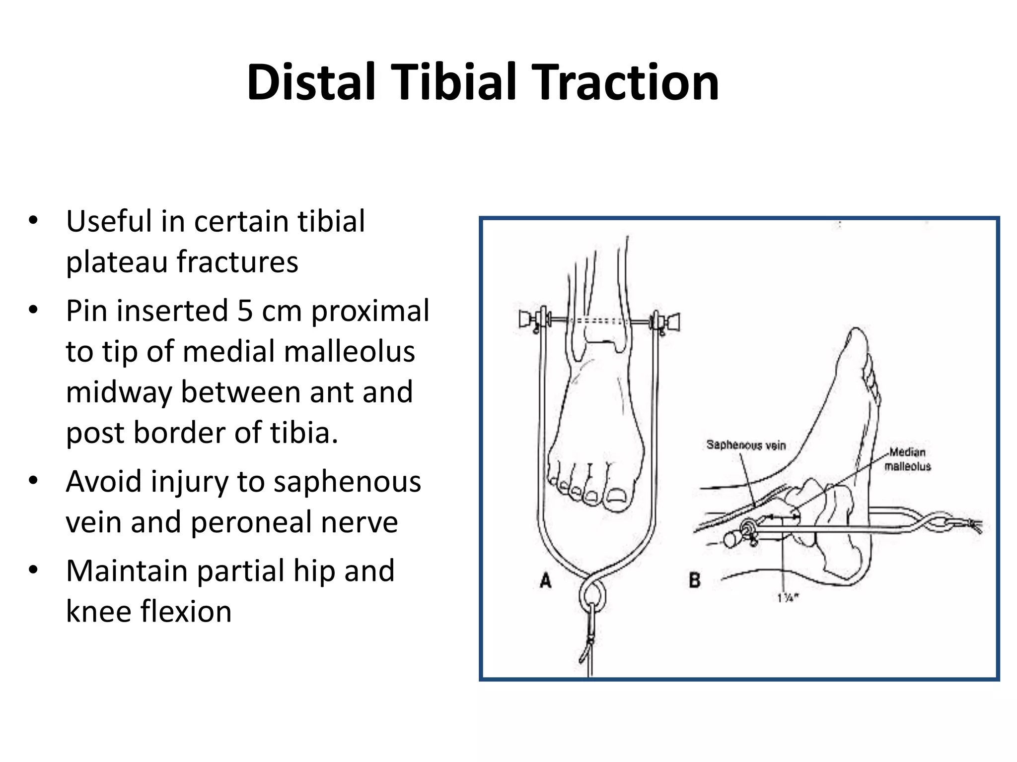 SPLINTS AND TRACTIONS IN ORTHOPAEDICS BY DR ATUL.pptx