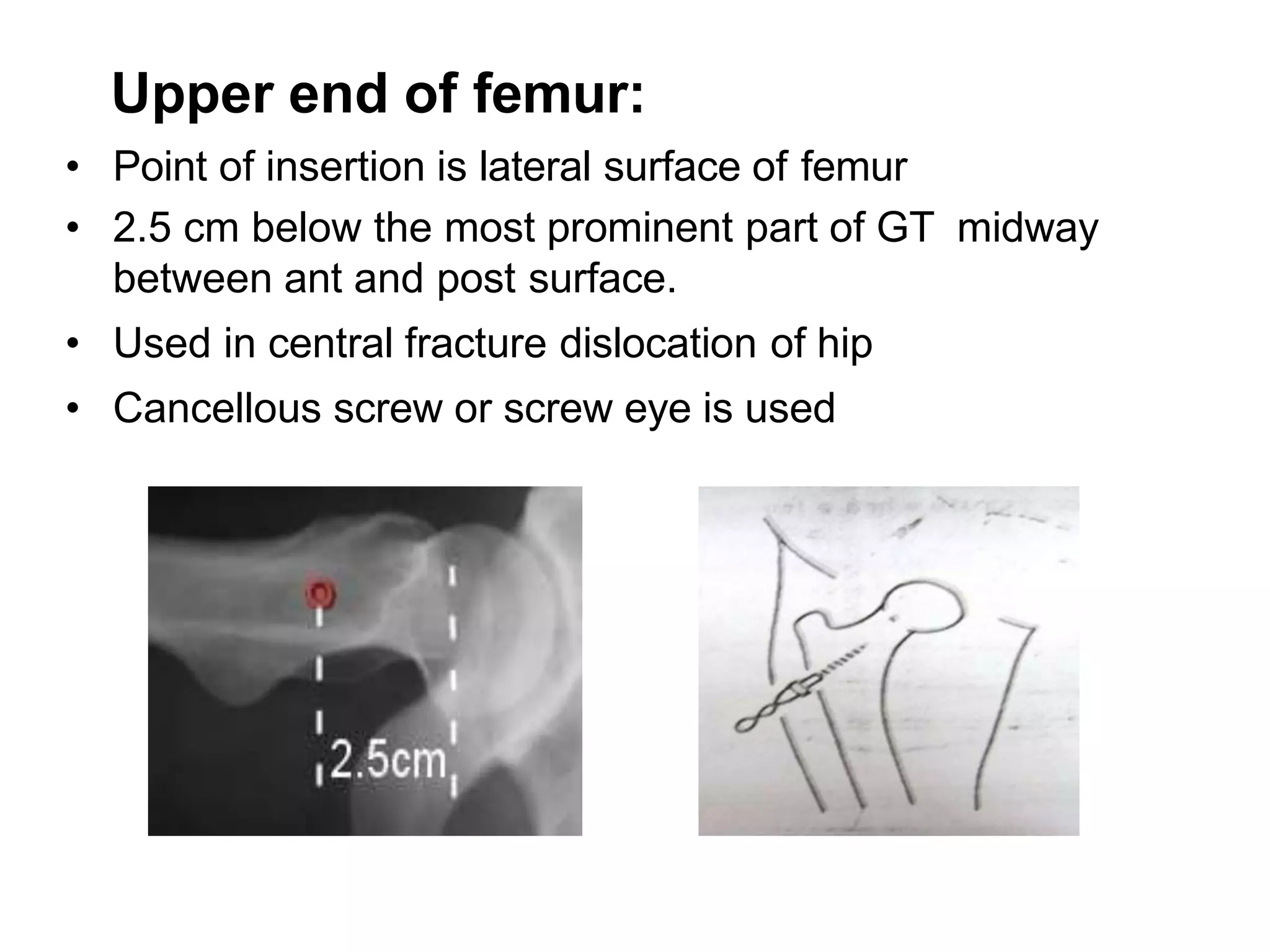 SPLINTS AND TRACTIONS IN ORTHOPAEDICS BY DR ATUL.pptx